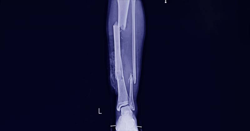 Tíbia e fíbula: como são as fraturas e tratamentos?