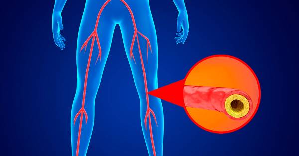 Ateromatose: o que é, quais os tratamentos e sintomas? | Dr. Douglas Khalil