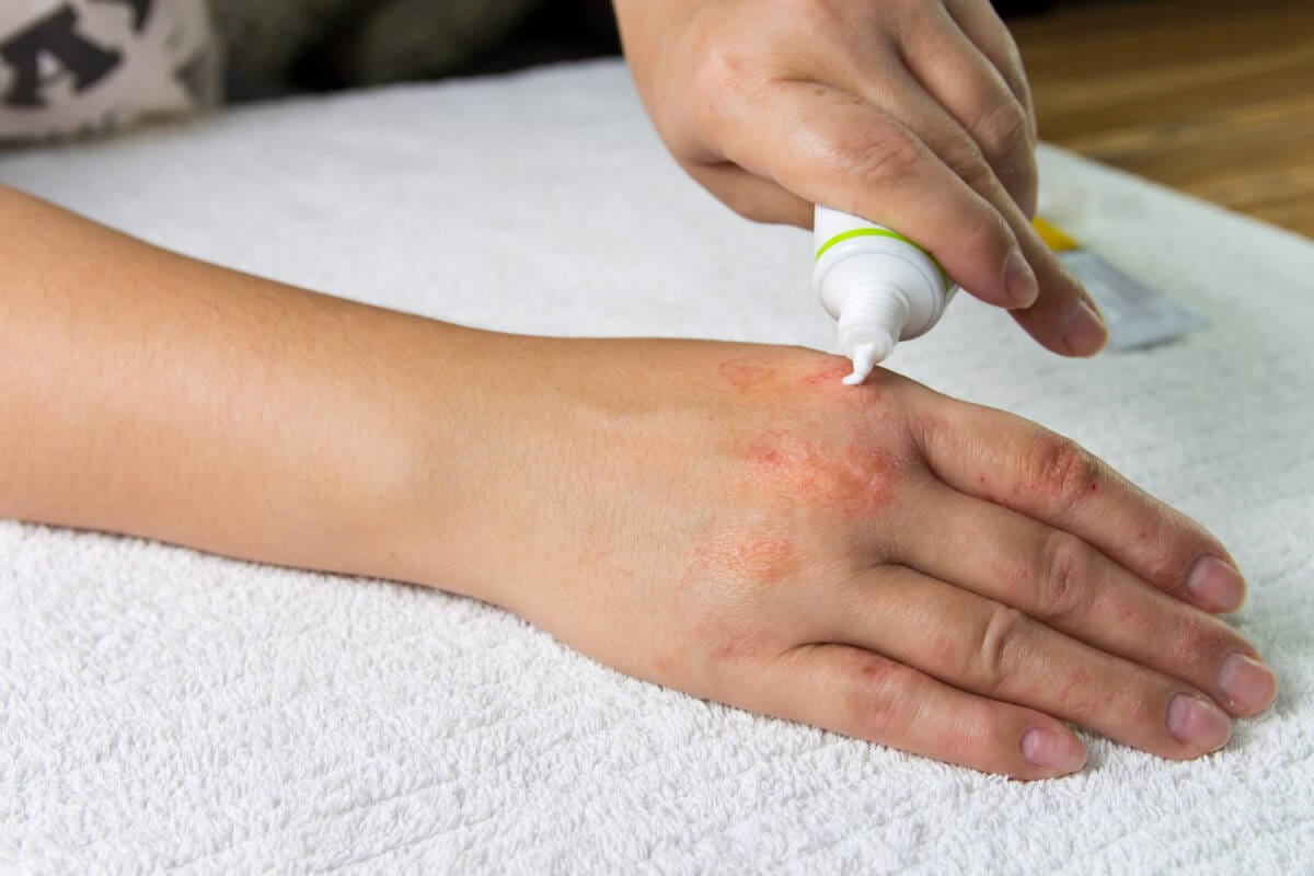 Dermatite: o que é, sintomas, tipos e como tratar